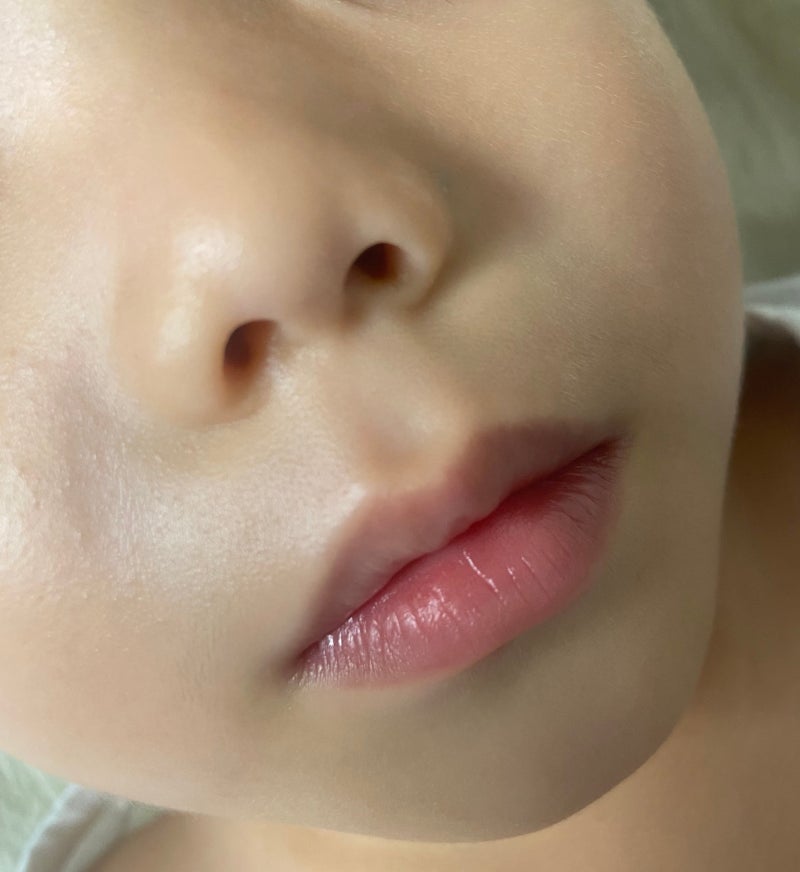 아기 입술 찢어짐 상처와 회복 과정 네이버 블로그