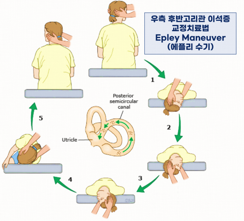 이석증 메니에르 전정신경염 어지러움의 3대장 네이버 블로그