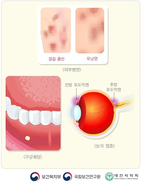 베체트병 류마티스내과 진단 및 검사 비용 후기hla B51 희귀난치성 자가면역질환 네이버 블로그