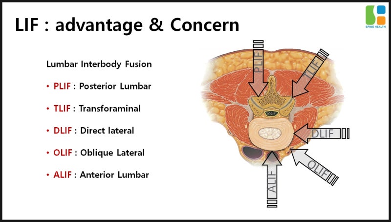 요추 유합술의 종류와 차이점 ALIF, DLIF, OLIF, PLIF, TLIF / 허리디스크, 협착증, 전방전위증 퓨전 수술 ...