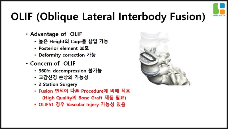 요추 유합술의 종류와 차이점 Alif Dlif Olif Plif Tlif 허리디스크 협착증 전방전위증 퓨전 수술