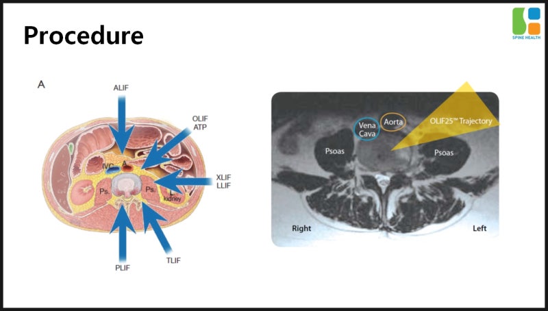 요추 유합술의 종류와 차이점 ALIF, DLIF, OLIF, PLIF, TLIF / 허리디스크, 협착증, 전방전위증 퓨전 수술 ...