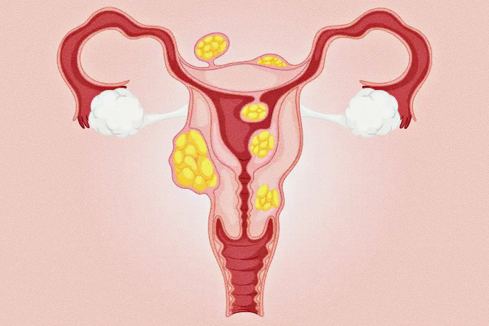 자궁 근종물혹 증상 및 원인과 검사 치료 수술 예방 크기 통증 폐경기 임신 네이버 블로그