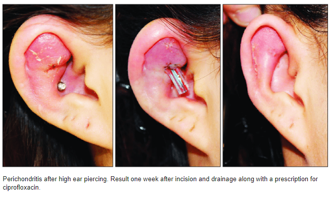 이개(auricle, 귓바퀴) 질환 - 외상, 감염과 염증, 선천성 이개전부 누공(Congenital preauricular ...