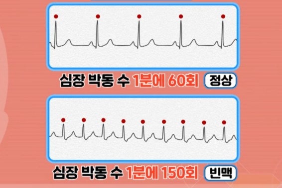 빈맥 증상 및 원인 빈맥성 부정맥 심실 기립성빈맥증후군 네이버 블로그