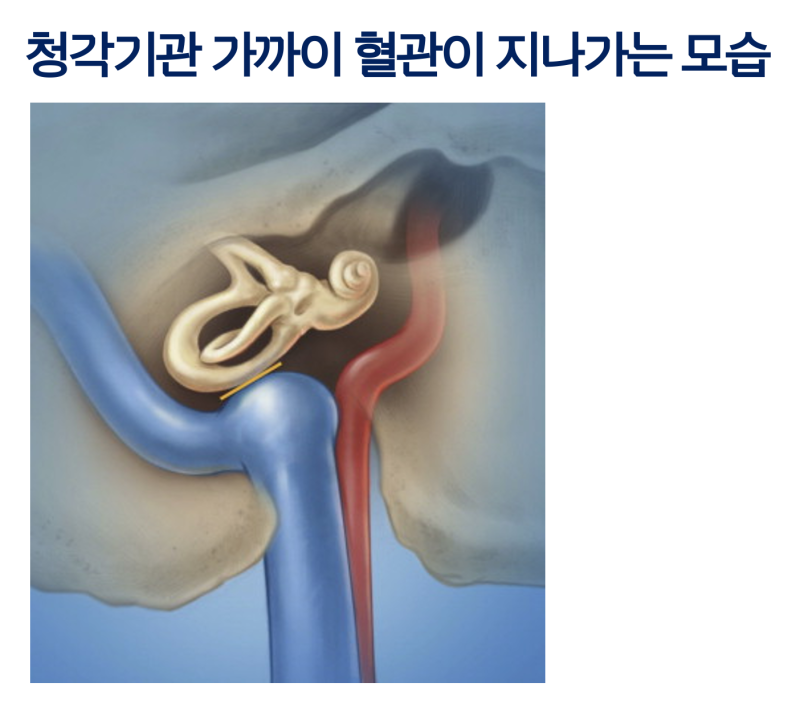 잠실아산 귀에서 맥박소리가 들려요 박동성 이명 네이버 블로그