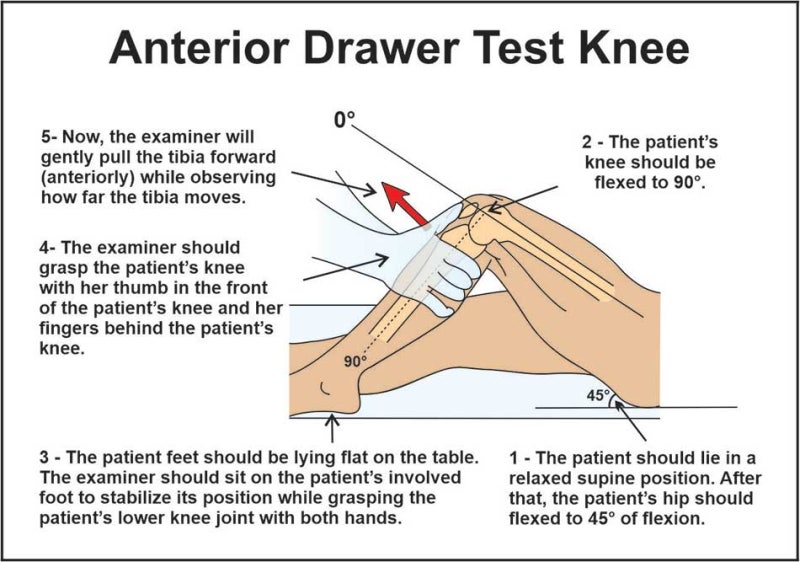 Anterior drawer test : 전방 당김 검사(전방 서랍 검사) - ACL 손상 : 네이버 블로그