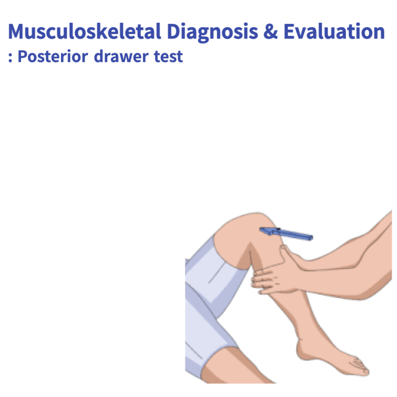 Posterior drawer test : 뒤쪽 밀기 검사(후방 서랍 검사) - PCL 손상 : 네이버 블로그