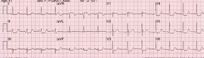 「심전도」 STE in aVR, DDx : 네이버 블로그