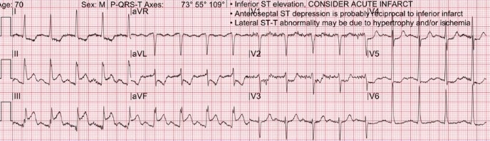 「심전도」 Inferior wall MI and right ventricular MI : 네이버 블로그