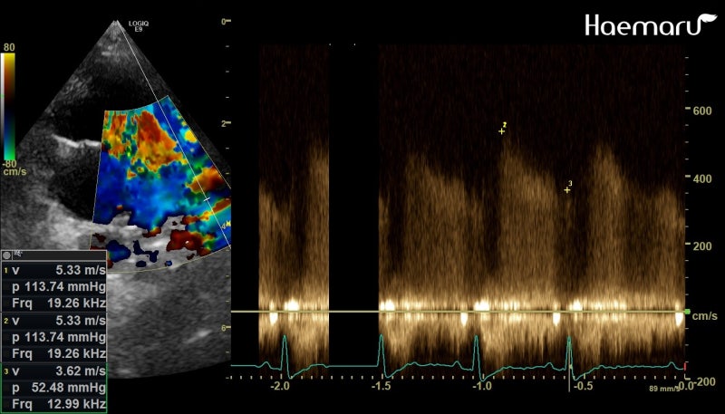 강아지 동맥관 개존증 PDA를 수술없이 치료하는 ACDO 시술 사례 (해마루 인터벤션센터) : 네이버 블로그