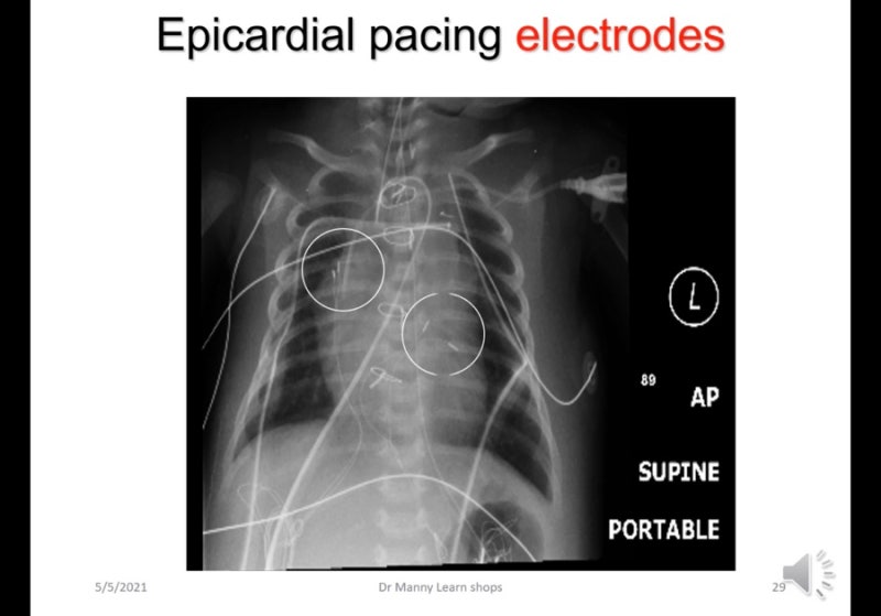 Pacemaker 인공심박동기 - Temporary cardiac pacing wire : 네이버 블로그