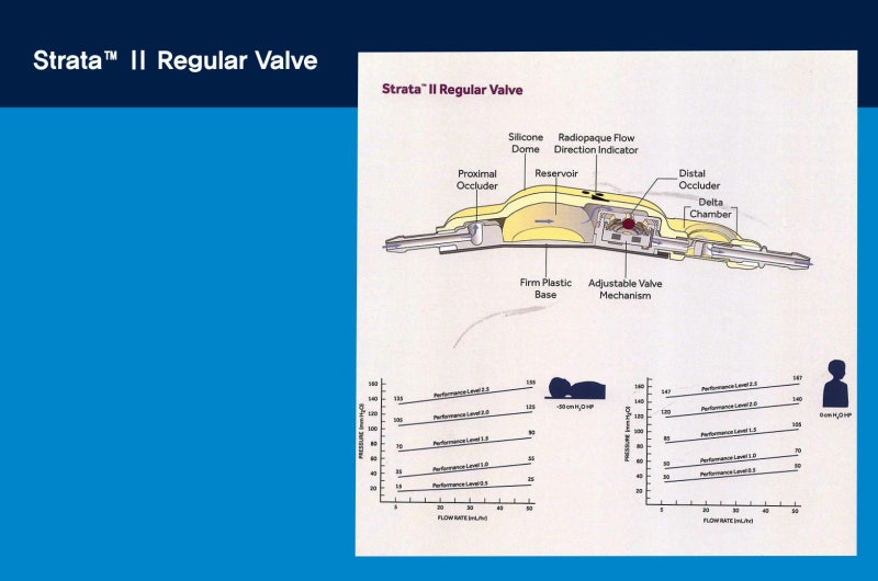 [제품소개]VP Shunt: Strata™ 조절 가능한 압력 밸브 제품군 : 네이버 블로그