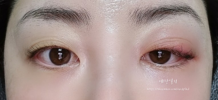 눈 다래끼 치료 후기 3~5일차 스테로이드성 항염증제 소염제 주사 붓기 증상 네이버 블로그