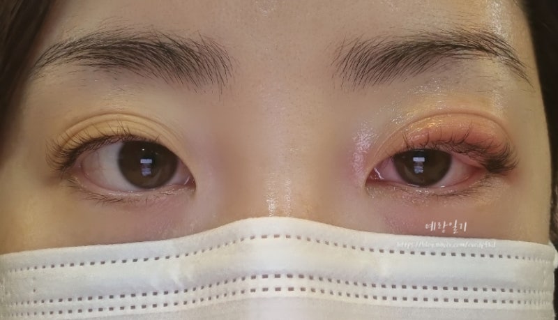 눈 다래끼 치료 후기 3~5일차 스테로이드성 항염증제 소염제 주사 붓기 증상 네이버 블로그
