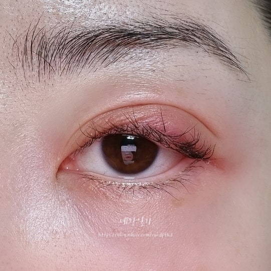 눈 다래끼 치료 후기 3~5일차 스테로이드성 항염증제 소염제 주사 붓기 증상 네이버 블로그