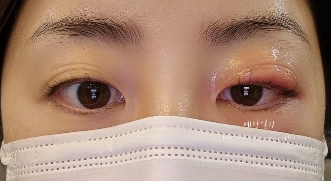 눈 다래끼 치료 후기 3~5일차 스테로이드성 항염증제 소염제 주사 붓기 증상 네이버 블로그
