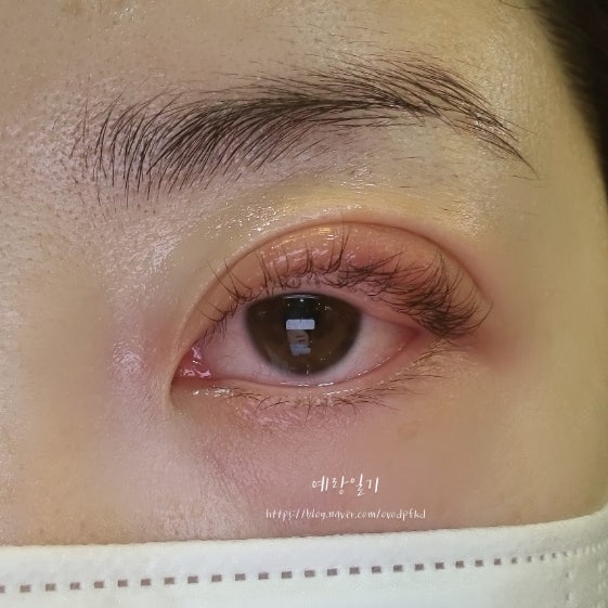 눈 다래끼 치료 후기 3~5일차 스테로이드성 항염증제 소염제 주사 붓기 증상 네이버 블로그