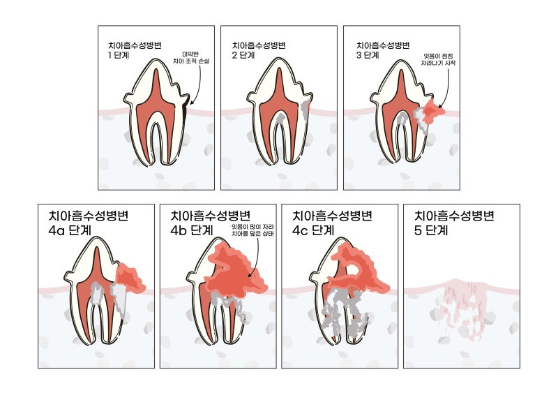 치아흡수성병변 (FORL : Feline Odontoplastic Resorptive Lesion) : 네이버 블로그