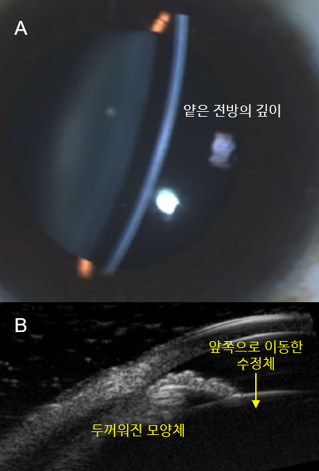 녹내장 치료약 부교감신경 작용제축동제 이솝토카핀 오큐카르핀 네이버 블로그