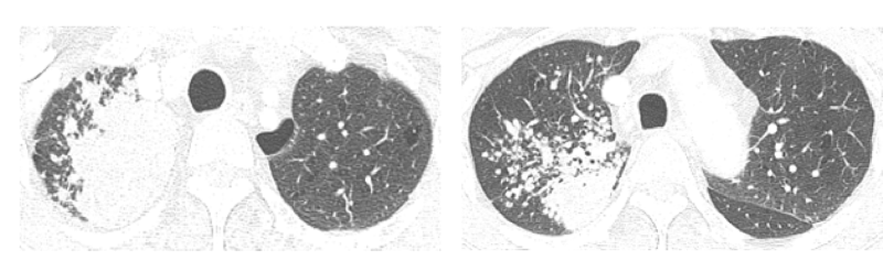 활동성 폐결핵 폐엑스레이 증례 결핵 X Ray 간유리음영 폐경화 네이버 블로그