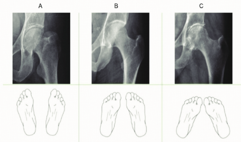 골반 틀어짐의 원인 - 고관절의 회전(anteversion, retroversion) : 네이버 블로그