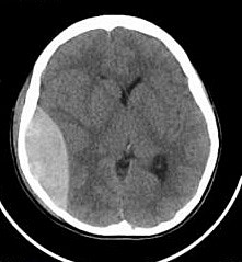 뇌출혈 종류에 따라 사용되는 의학용어 SDH, SAH, ICH, IVH, EDH : 네이버 블로그