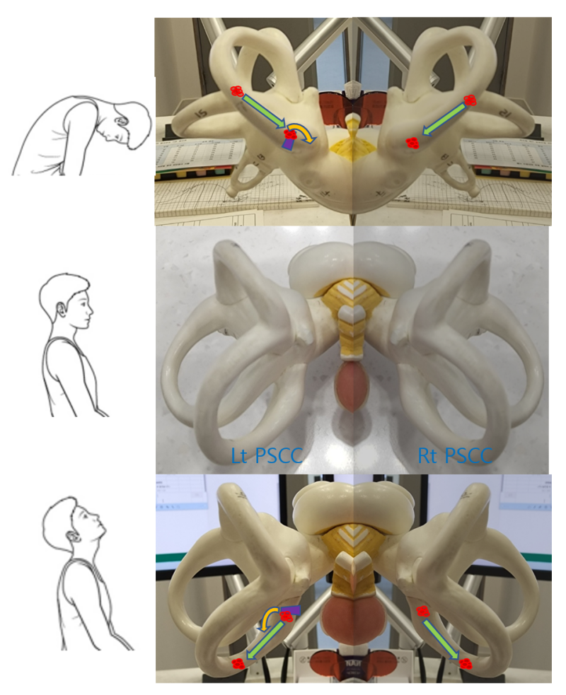 [전주 이석증] [논문 리뷰] Bow and Lean test에서 나타나는 Vertical Nystagmus는 PSCC BPPV ...