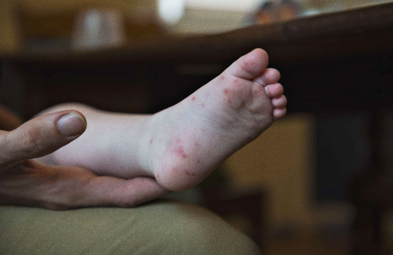 수족구 병 초기 증상 및 원인 잠복기 전염전염성 기간 경로 치료약 연고 예방 수포 관리 병원 성인