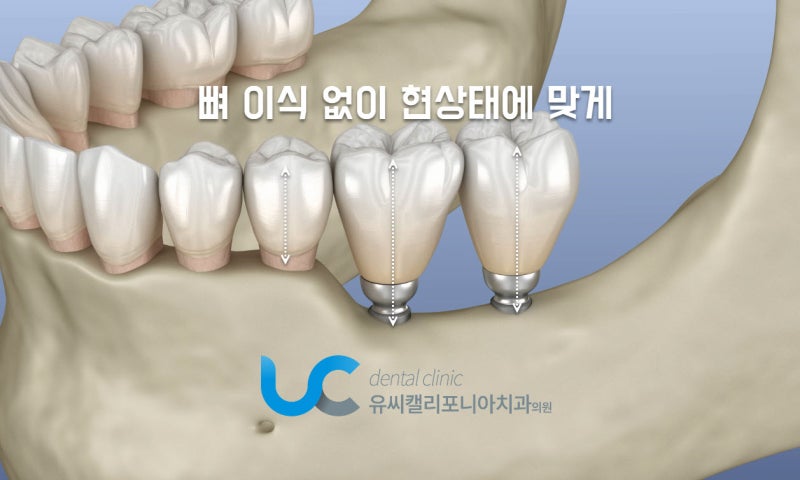 어금니 발치후 임플란트 수술 과정비교 네이버 블로그