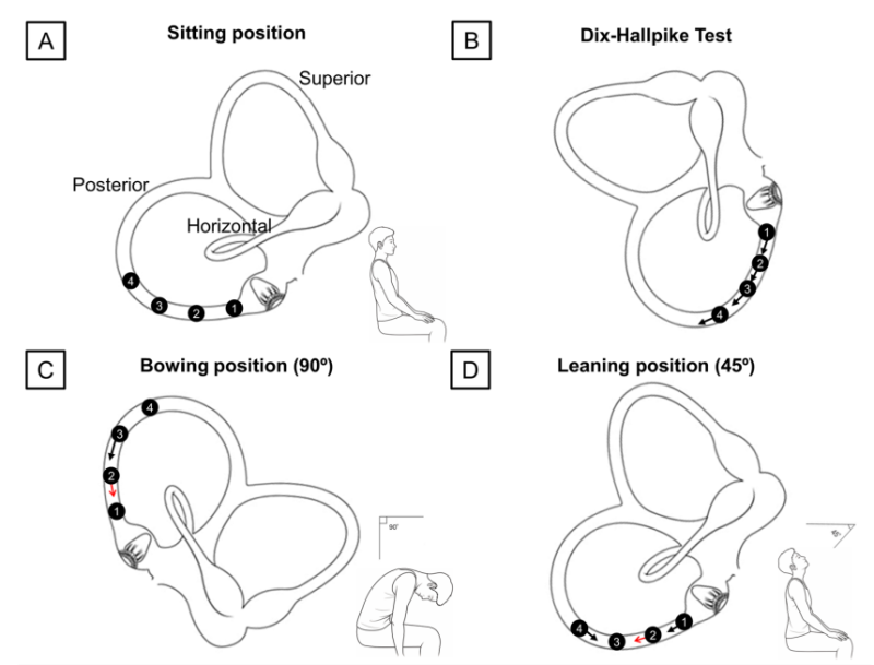 [전주 이석증] [논문 리뷰] Bow and Lean test에서 나타나는 Vertical Nystagmus는 PSCC BPPV ...