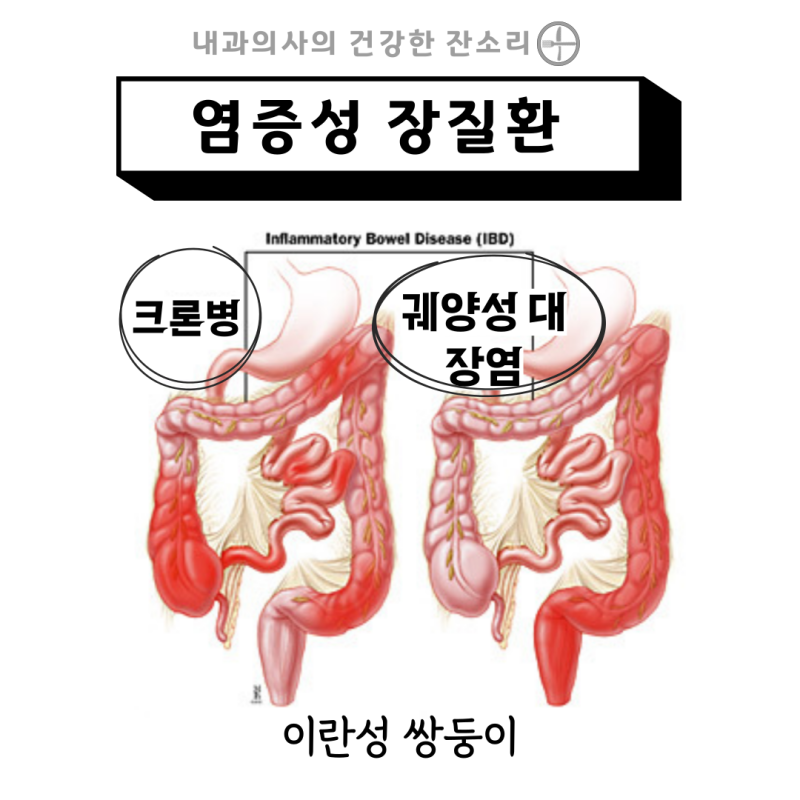궤양성대장염 환자입니다 주요 증상은 복통 혈변 설사 네이버 블로그