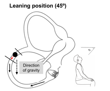 [전주 이석증] [논문 리뷰] Bow and Lean test에서 나타나는 Vertical Nystagmus는 PSCC BPPV ...