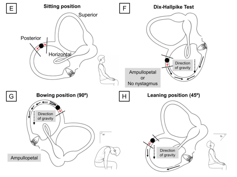 [전주 이석증] [논문 리뷰] Bow and Lean test에서 나타나는 Vertical Nystagmus는 PSCC BPPV ...
