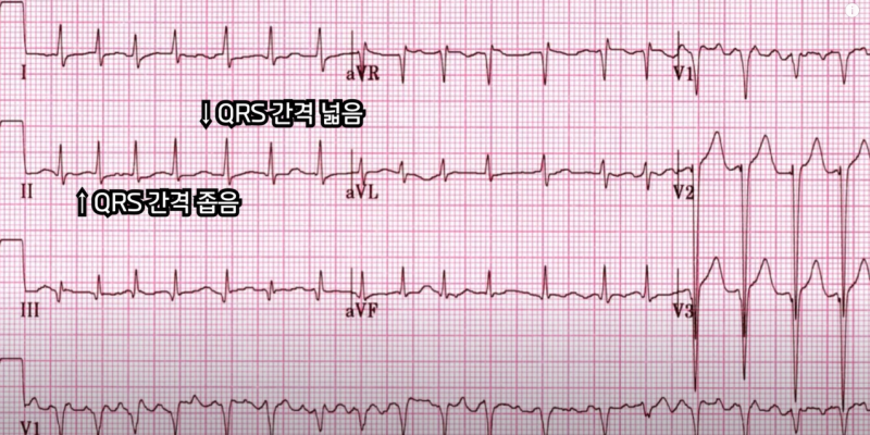 AF(Atrial fibriilation) : 심방세동 AF CVR, AF RVR,AF SVR : 네이버 블로그
