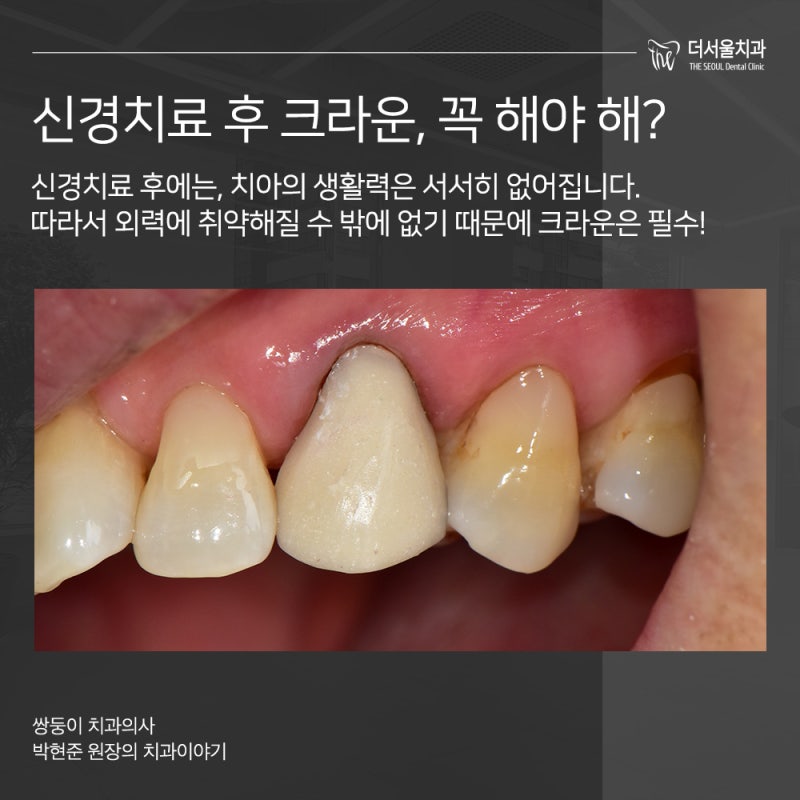 신경치료 후 크라운 꼭 해야 되는 이유를 설명드립니다 네이버 블로그