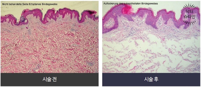 'LDM 관리'가 뭐야?(물방울리프팅,초음파관리,원리,효과,장점,주의사항,부작용) : 네이버 블로그