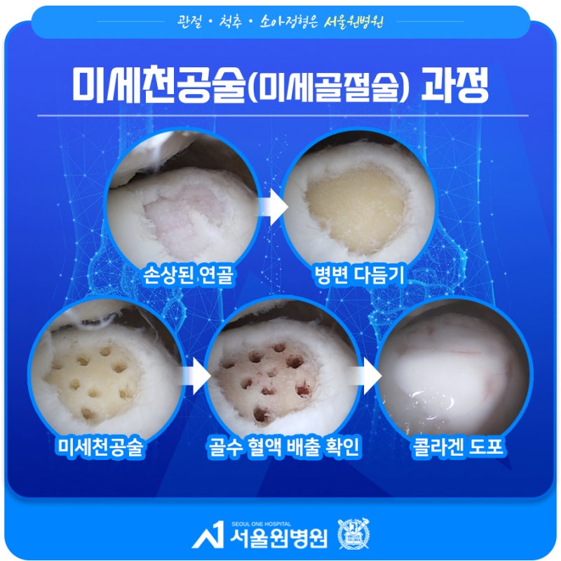 3 미세천공술 무릎통증 개선 위한 연골재생 솔루션 미세골절술 네이버 블로그