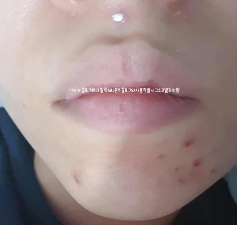 여드름 흉터 치료 Tca 도트필 셀프 자가 후기 5탄 레티놀트레티노인을 곁들인 네이버 블로그