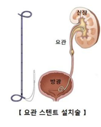 PCN, DJ STENT : 네이버 블로그