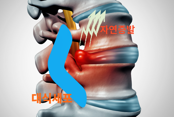 허리디스크 터지면 이 방법으로 자연치유 됩니다 네이버 블로그