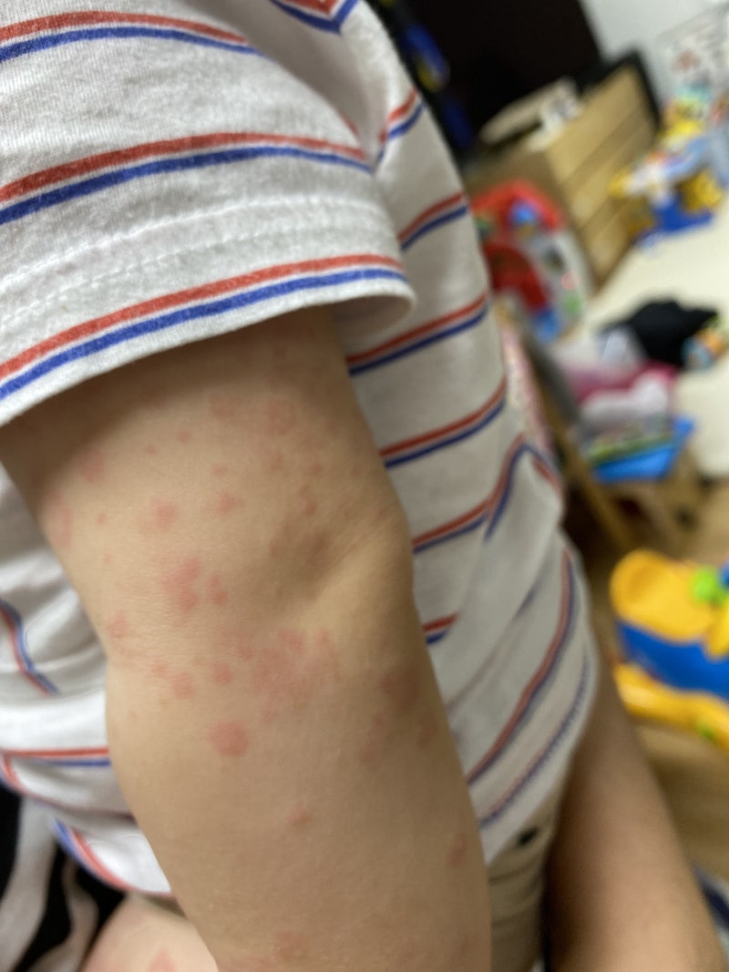코로나 피부 발진 13개월 아기 피부 두드러기코로나 확진😭 네이버 블로그