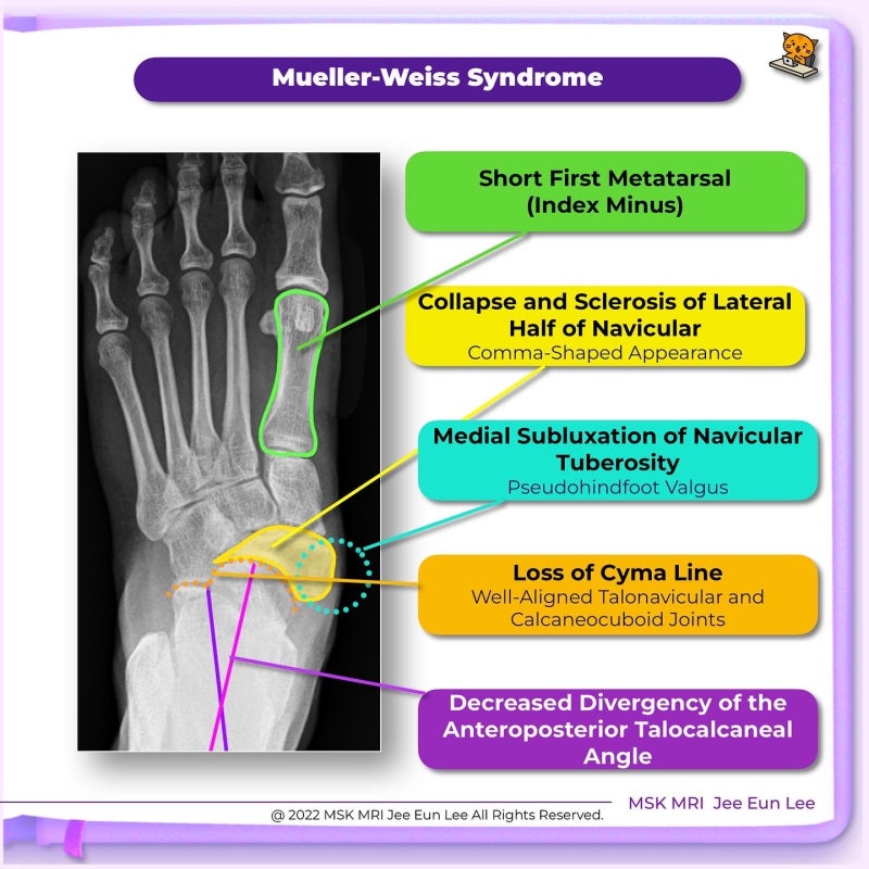 [Ankle/foot_Case_#02] [Challenging level] Mueller-Weiss syndrome : 네이버 블로그