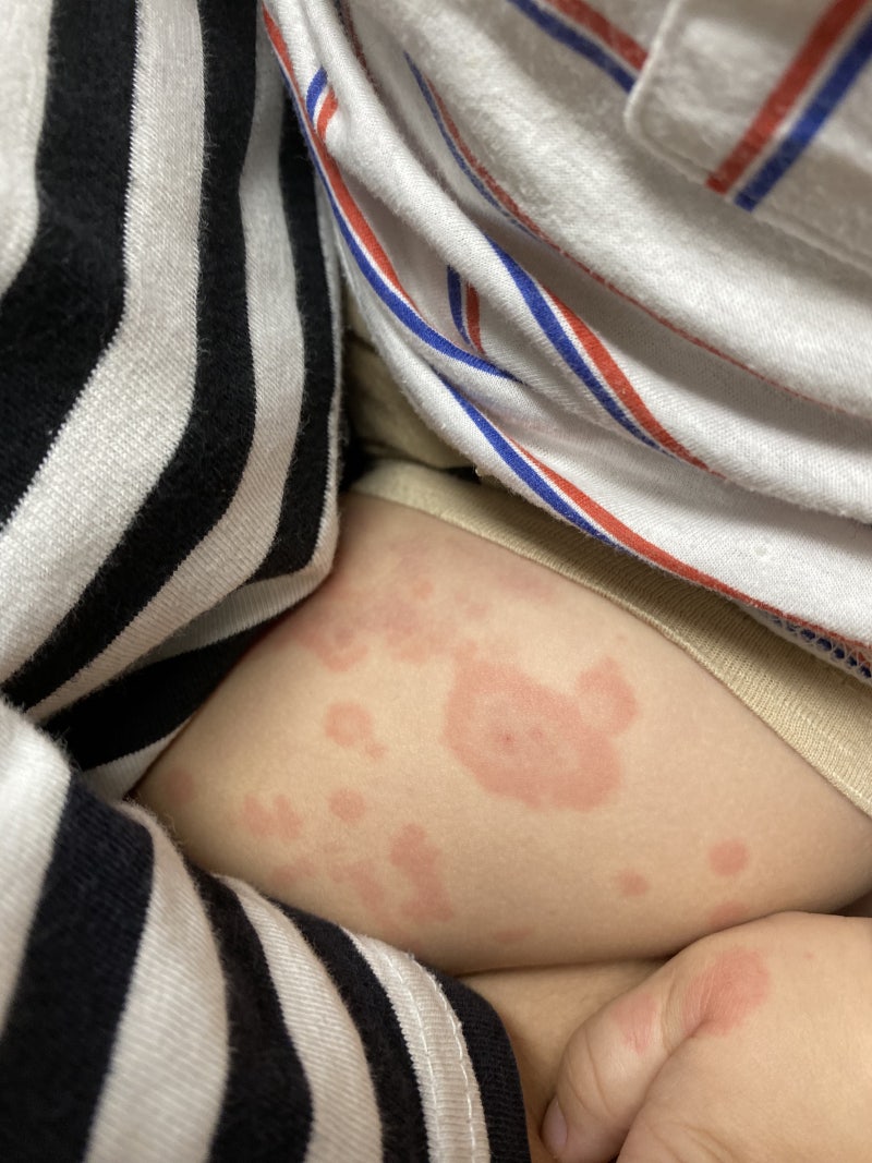 코로나 피부 발진 13개월 아기 피부 두드러기코로나 확진😭 네이버 블로그