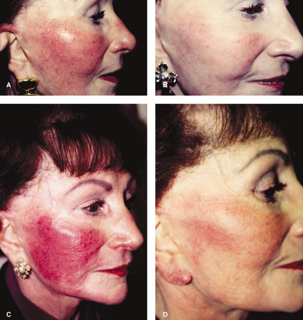 상열감과 붉은 얼굴 Burning Red Face Syndrome : 네이버 블로그