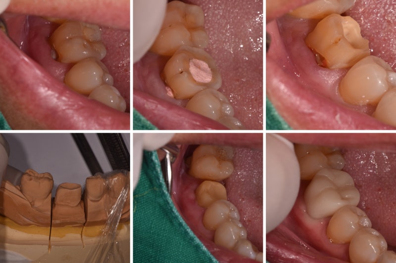 치경부 마모증, abfraction, 치아 뿌리 잇몸 패임 신경치료 필요한 경우 : 네이버 블로그