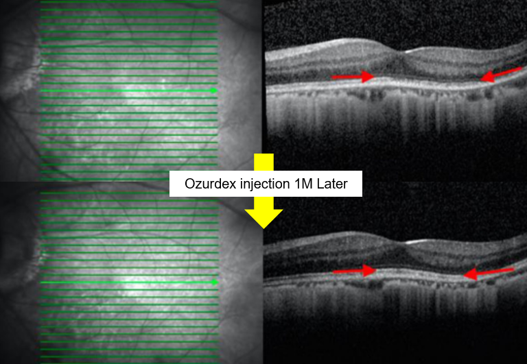 급성 구역 잠복 외망막병증(AZOOR): 정의, 원인, 발병기전, 증상, 소견, 진단, 치료, 예후 : 네이버 블로그