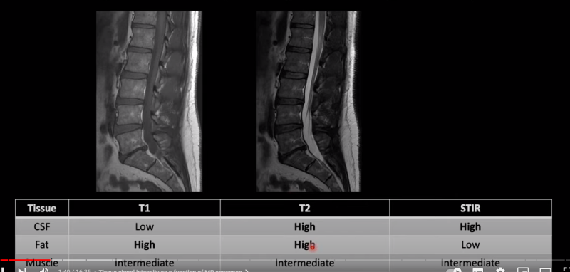 [통증정리] spine MRI reading part.2 (stanford UV) : 네이버 블로그