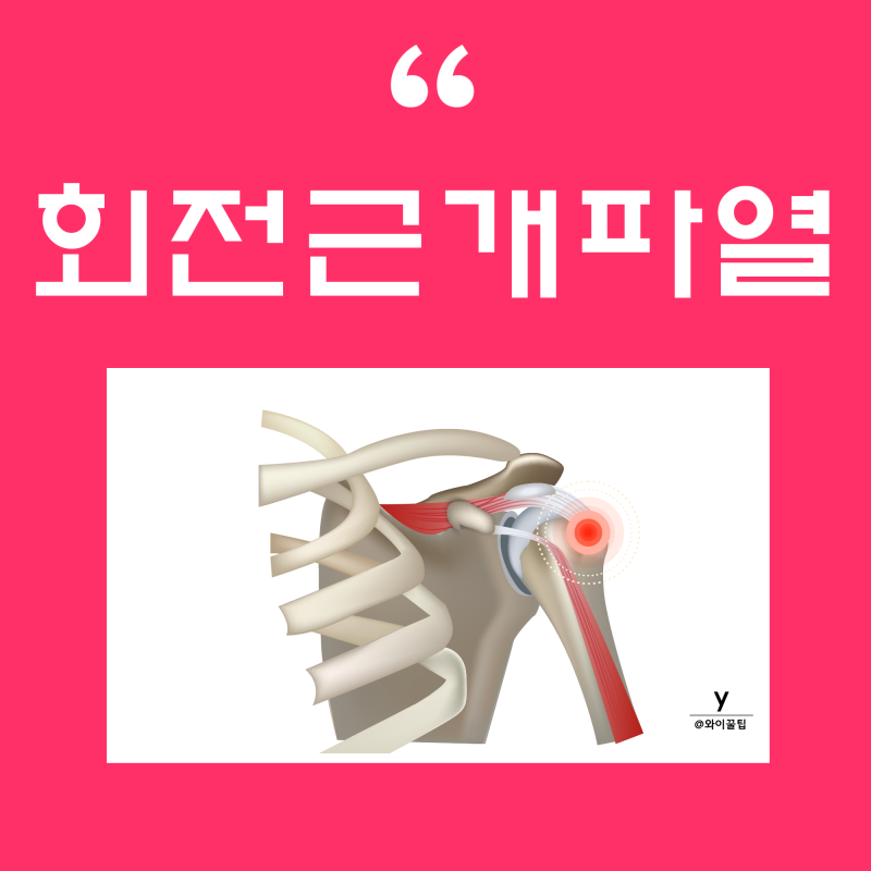어깨회전근개파열 원인 5가지 증상 운동 어깨 근육파열 통증 치료 오른쪽 왼쪽 네이버 블로그
