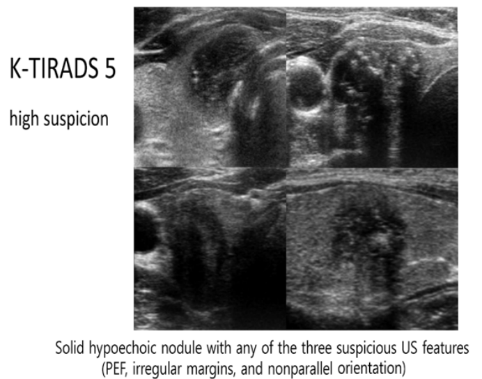 K-TIRADS 2021개정판 총정리 (증례로 보는 갑상선 결절의 최신지견) : 네이버 블로그